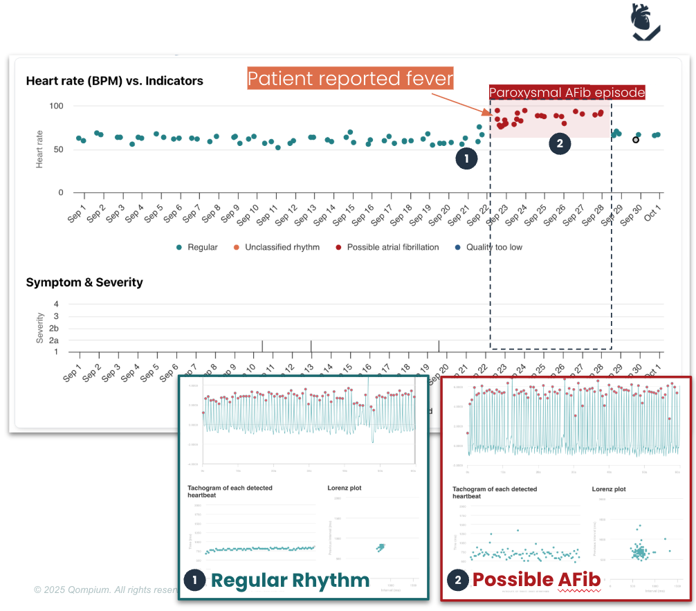 Fever triggered an asymptomatic AFib episode that resolved in 4 days ...