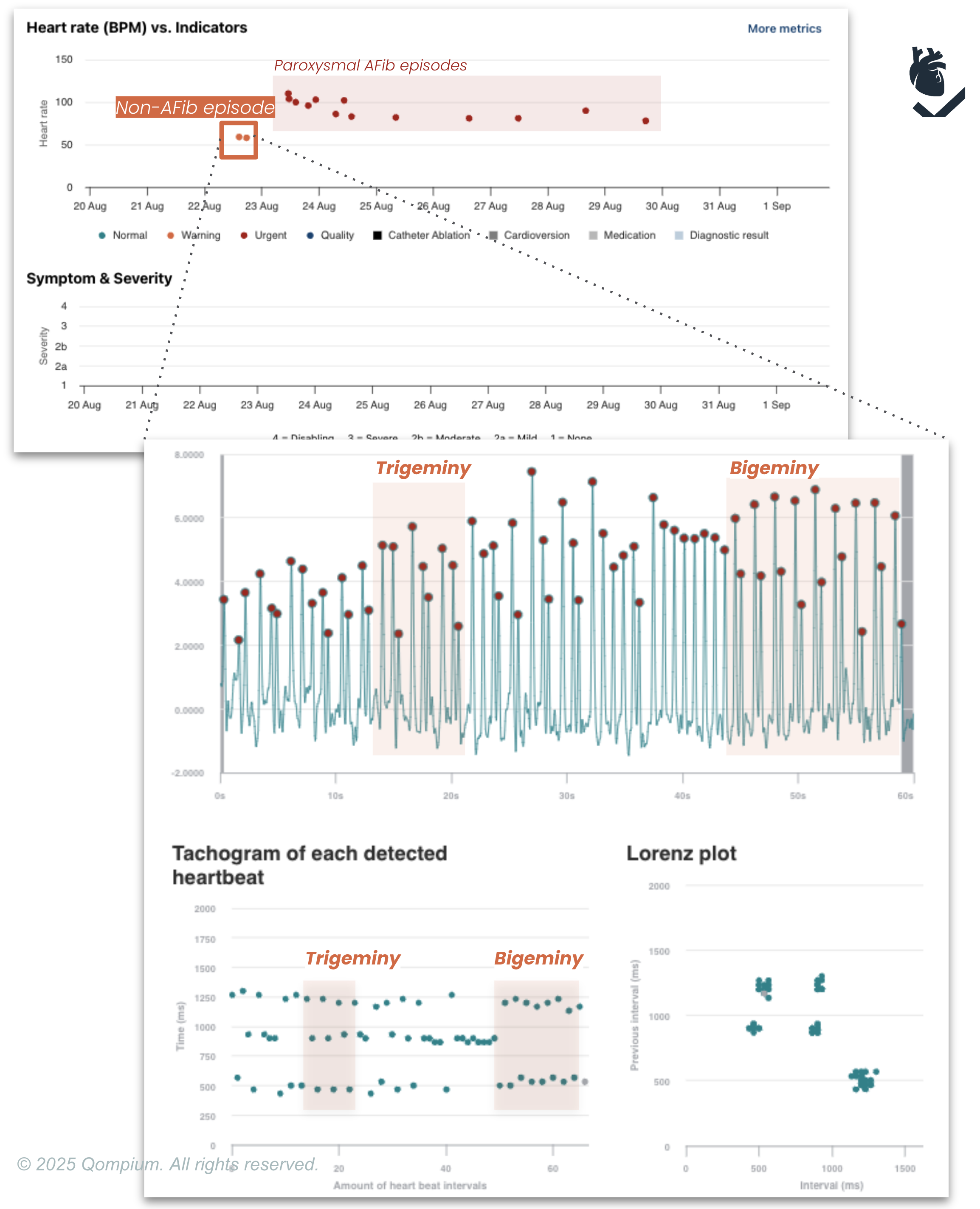🟠 Short asymptomatic transition from trigeminy to bigeminy – FibriCheck ...